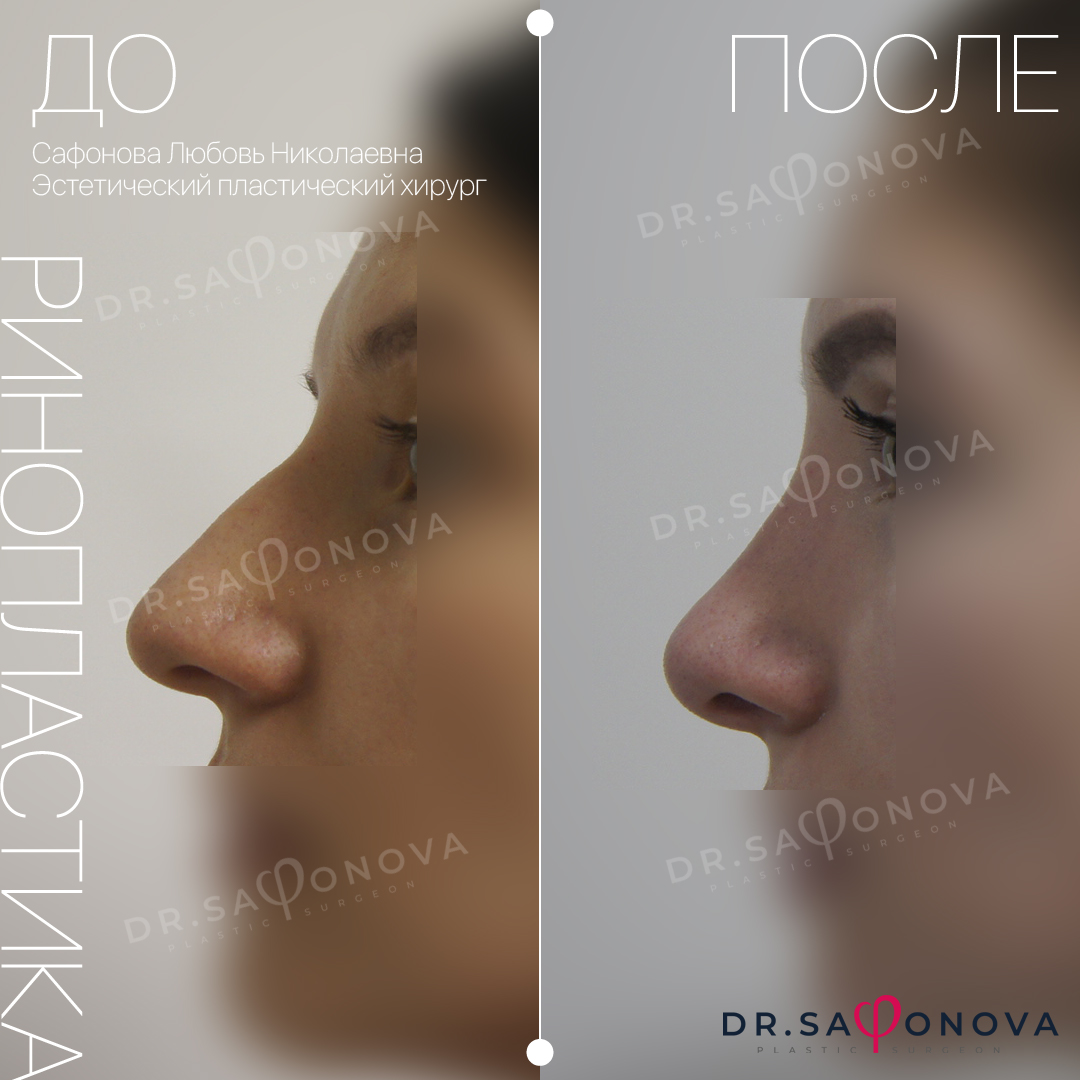 Ринопластика в Санкт-Петербурге - цены на пластику носа в Институте ...